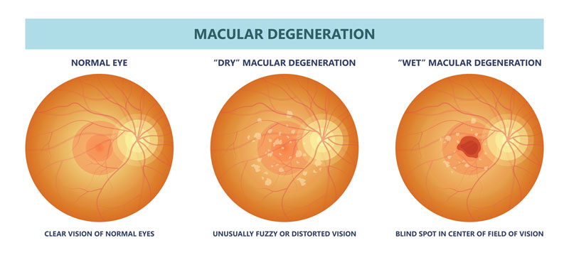 Macular Degeneration - Red Cliffs Eye Center