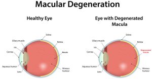 Macular Degeneration - Red Cliffs Eye Center