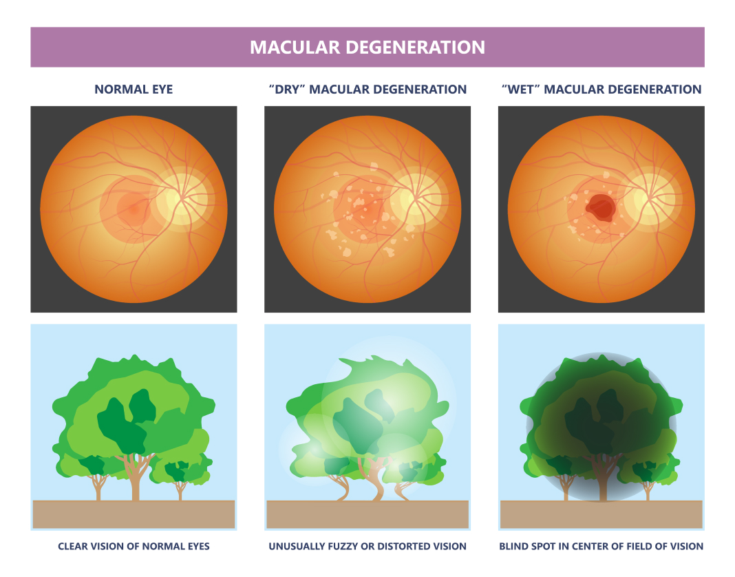 Macular Degeneration Red Cliffs Eye Center